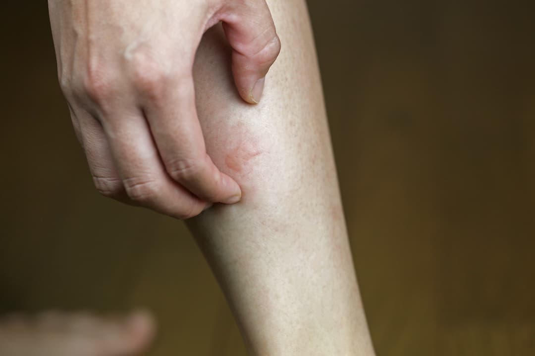 A Guide To Pests That Sting | Bees, Wasps & Hornets | Anaphylaxis